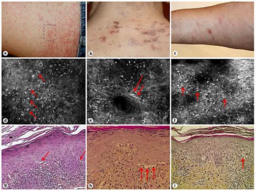 Signet Ring-Like Cells: A New Reflectance Confocal Microscopy Clue of ...