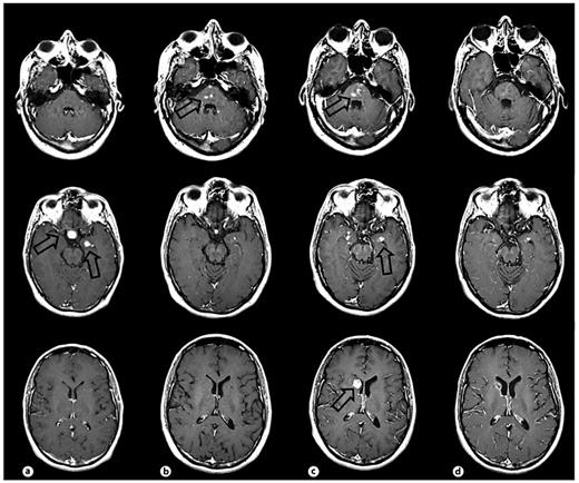 Cerebral and Cutaneous Involvements of Xanthoma Disseminatum ...