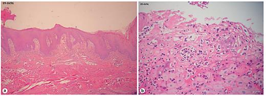 Oral Psoriasis: An Overlooked Enigma | Dermatology | Karger Publishers