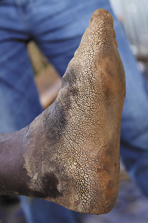 With Bare Feet in the Soil: Podoconiosis, a Neglected Cause of Tropical ...
