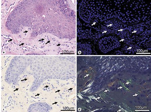 Diagnosis of Primary Cutaneous Amyloidosis by Rapid 4,6-Diamidino-2 ...