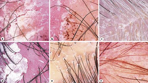 Diagnostic Accuracy of Trichoscopy in Inflammatory Scalp Diseases: A ...