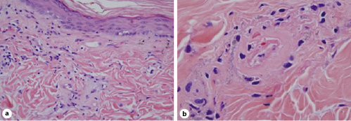 Atrophic Papulosis | Dermatology | Karger Publishers