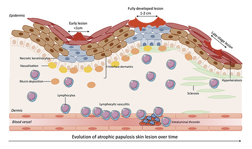 Atrophic Papulosis | Dermatology | Karger Publishers