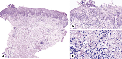 Acute Generalized Exanthematous Pustulosis: Clinical Characteristics ...