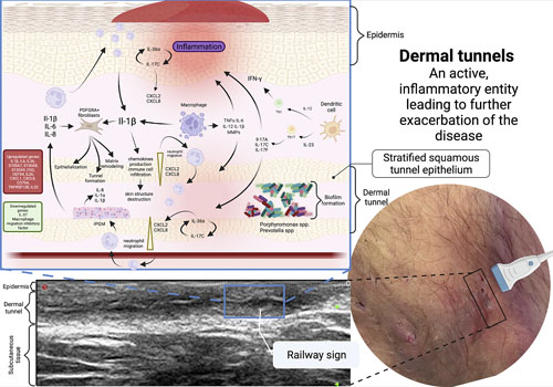 Tunnels in Hidradenitis Suppurativa: Active Inflammatory Entities with ...