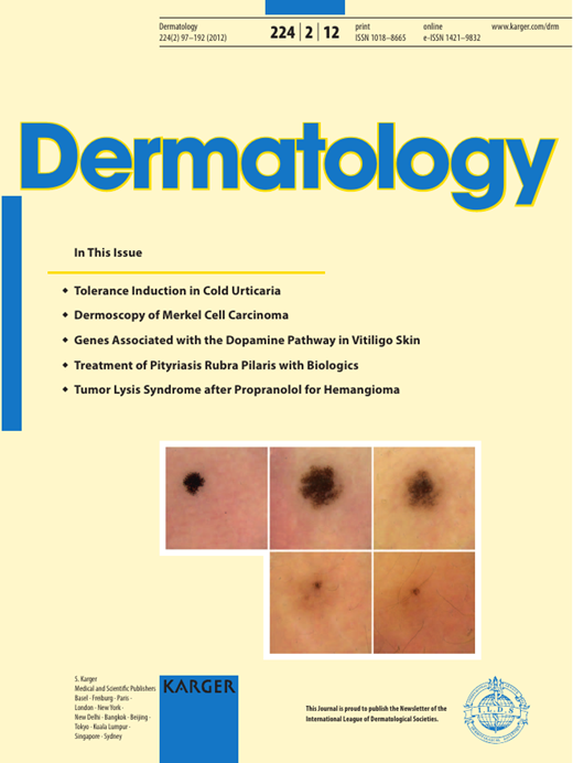 Multiple Basal Cell Carcinomas in a 38-Year-Old Woman with Goltz ...