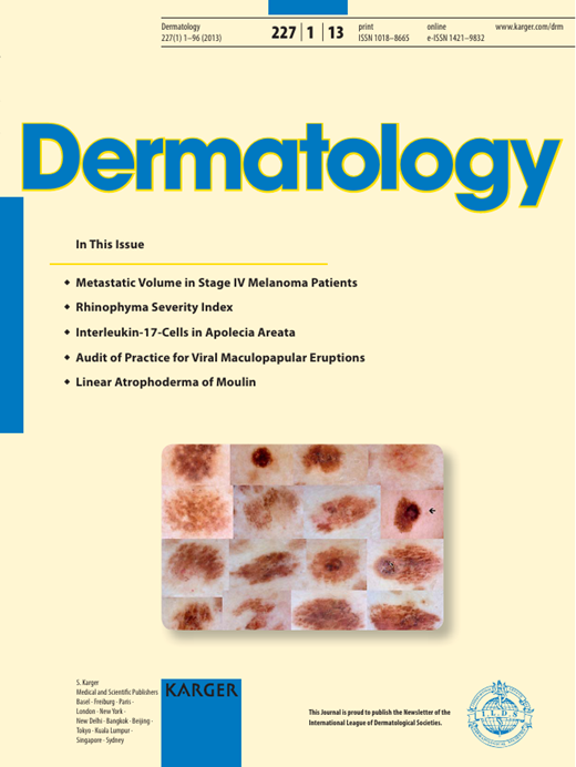 Linear Atrophoderma of Moulin: Report of 4 Cases and 20th Anniversary ...