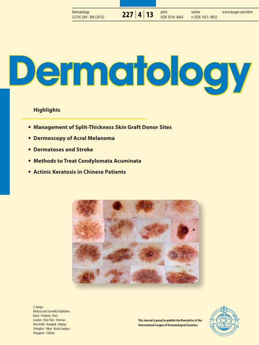 Primary Cutaneous Anaplastic Large Cell Lymphoma with Angioinvasive ...