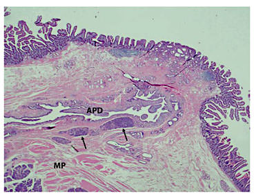 Histopathology of the Minor Duodenal Papilla | Digestive Surgery ...