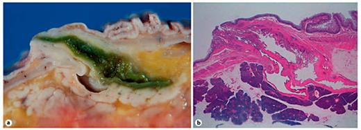 Major Duodenal Papilla and Its Normal Anatomy | Digestive Surgery ...