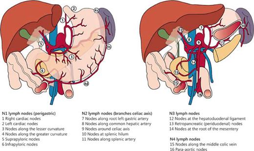 Lymph Node Dissection in Resectable Advanced Gastric Cancer | Digestive ...