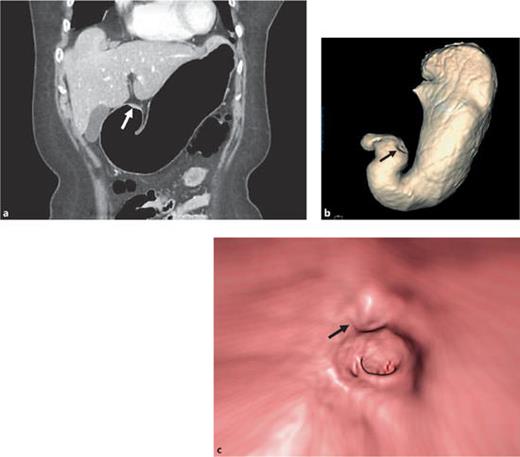 Gastric Cancer Staging with Radiologic Imaging Modalities and UICC ...