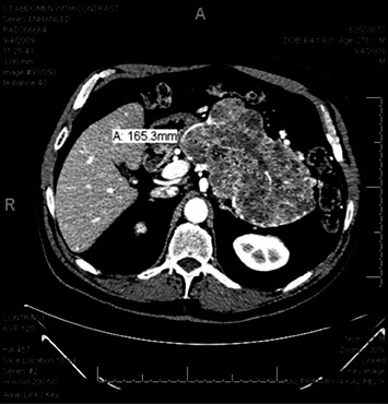 Serous Cystadenocarcinoma of the Pancreas: Clinical Features and ...