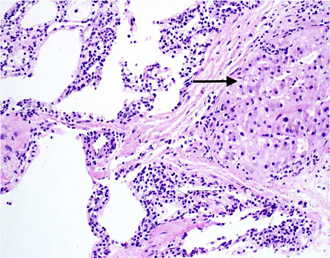 Serous Cystadenocarcinoma of the Pancreas: Clinical Features and ...