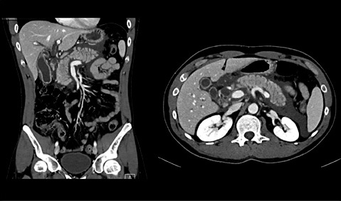 Recognition and Importance of New Definitions of Peripancreatic Fluid ...
