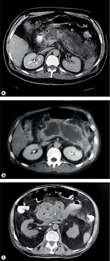 Recognition and Importance of New Definitions of Peripancreatic Fluid ...
