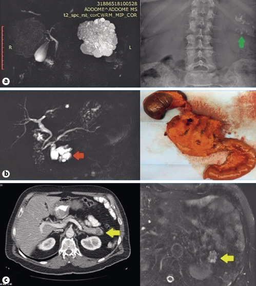 Management of Pancreatic Cystic Lesions | Digestive Surgery | Karger ...