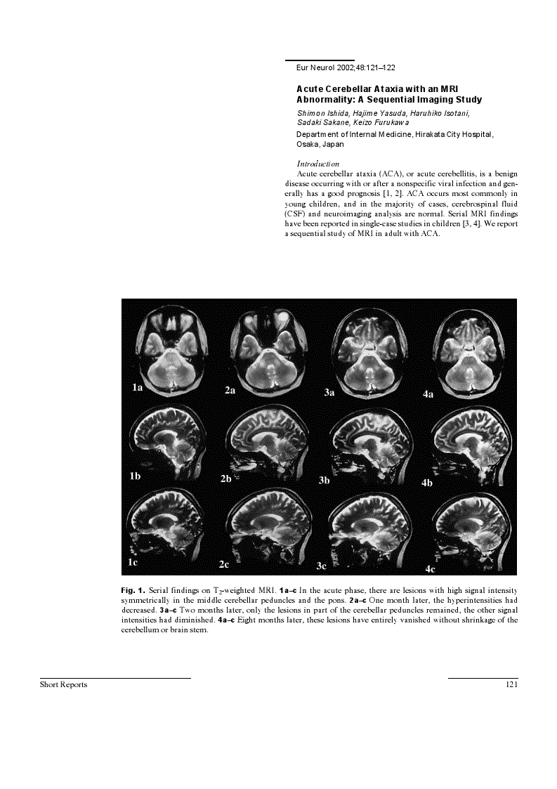 Acute Cerebellar Ataxia with an MRI Abnormality: A Sequential Imaging ...