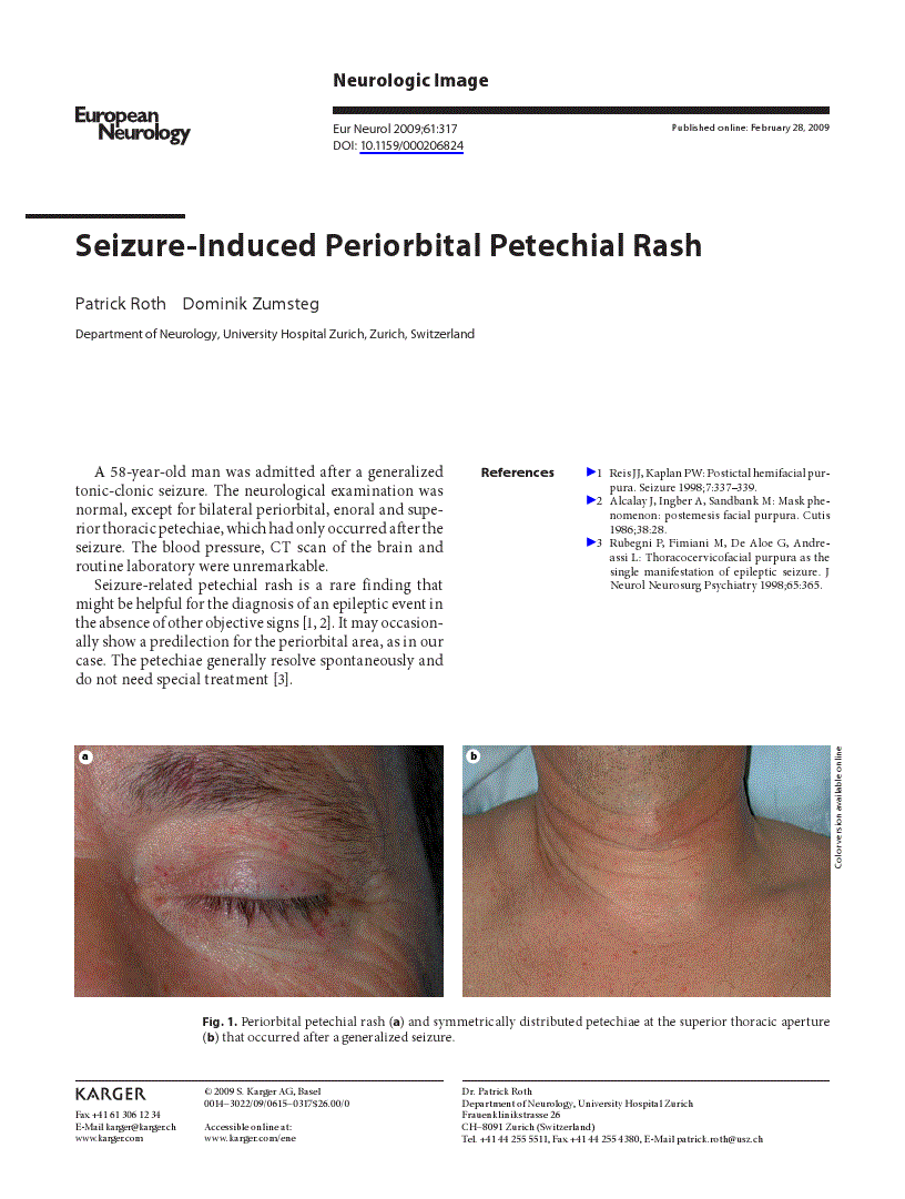 Seizure-Induced Periorbital Petechial Rash | European Neurology ...