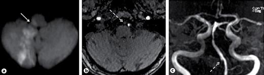 MRI of Cerebellar Infarction | European Neurology | Karger Publishers