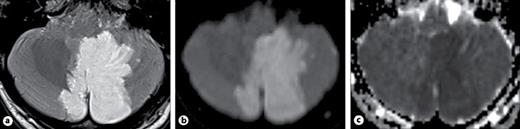 MRI of Cerebellar Infarction | European Neurology | Karger Publishers