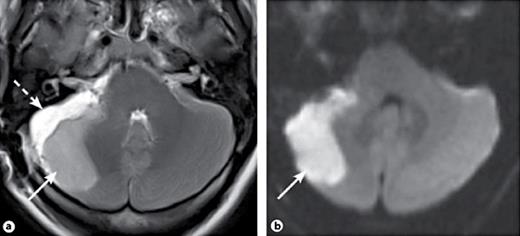 MRI of Cerebellar Infarction | European Neurology | Karger Publishers