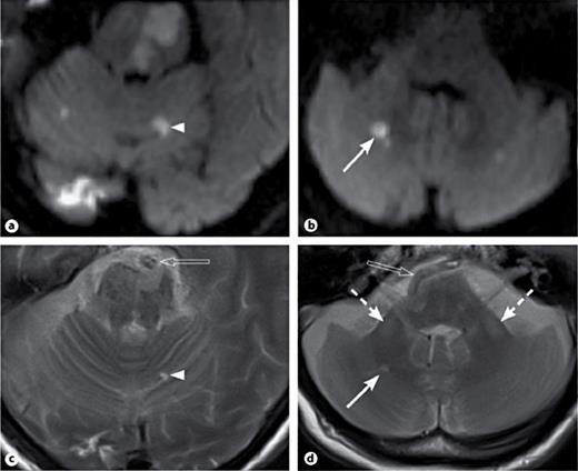 MRI of Cerebellar Infarction | European Neurology | Karger Publishers
