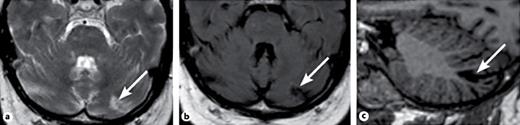 MRI of Cerebellar Infarction | European Neurology | Karger Publishers