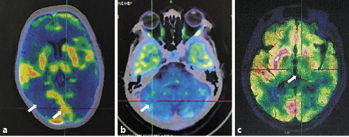 Sporadic Creutzfeldt-Jakob Disease: A Retrospective Analysis of 104 ...