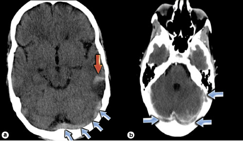 Cerebral Venous Thrombosis: A Comprehensive Review | European Neurology ...