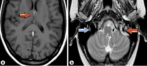 Cerebral Venous Thrombosis: A Comprehensive Review | European Neurology ...
