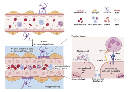 Microcirculation No-Reflow Phenomenon after Acute Ischemic Stroke ...