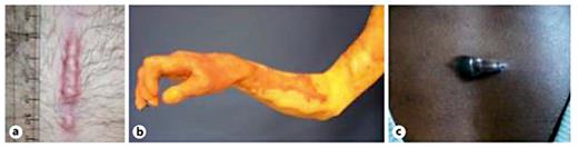 Skin Wound Healing: An Update on the Current Knowledge and Concepts ...