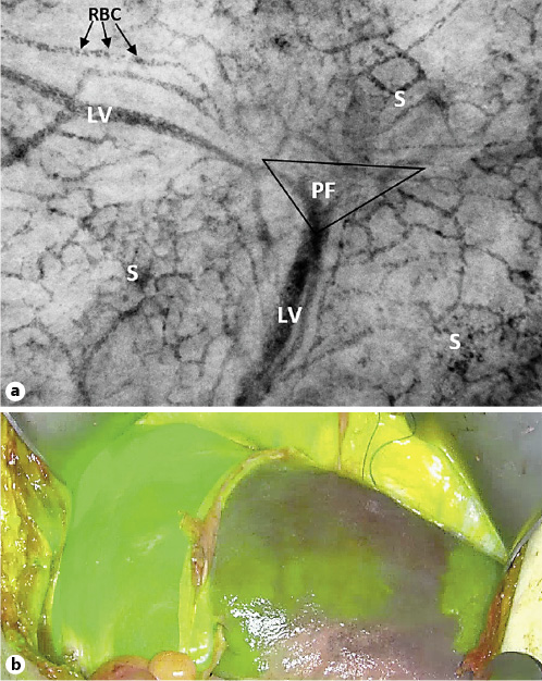 Intraoperative Imaging Techniques to Visualize Hepatic (Micro)Perfusion ...