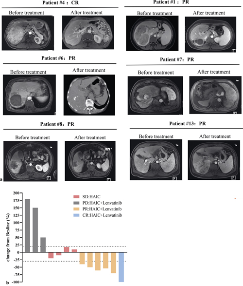 Analysis on Efficacy of Hepatic Artery Infusion Chemotherapy with or ...