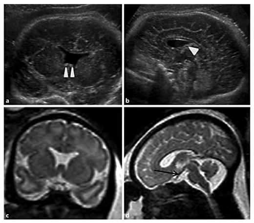 Main Congenital Cerebral Anomalies: How Prenatal Imaging Aids ...