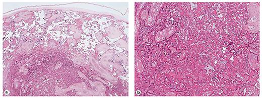 Placental Pathology in Early-Onset and Late-Onset Fetal Growth ...