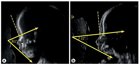 Prenatal Identification of Pierre Robin Sequence: A Review of the ...