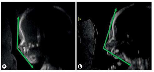Prenatal Identification of Pierre Robin Sequence: A Review of the ...