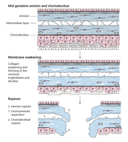 Why Do the Fetal Membranes Rupture Early after Fetoscopy? A Review ...