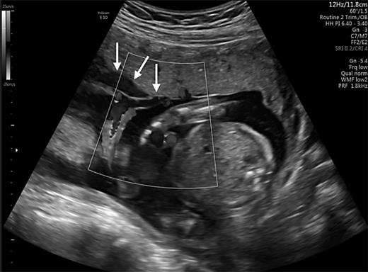 Subamniotic Hemorrhage, a Possible New Presentation of Fetal and ...