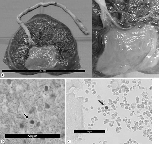 Subamniotic Hemorrhage, a Possible New Presentation of Fetal and ...