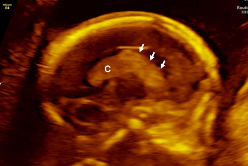 Cerebral Lateral Ventricular Asymmetry: Normal Variant or an Indicator ...
