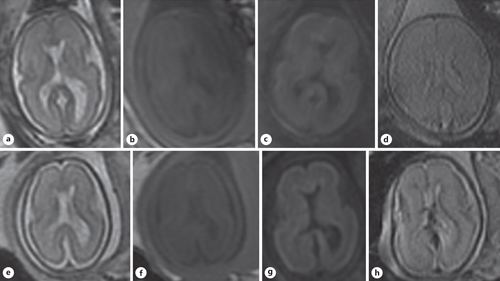 Cerebral Lateral Ventricular Asymmetry: Normal Variant or an Indicator ...