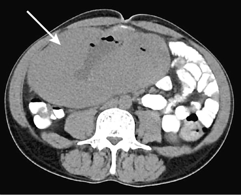 Huge Gastrointestinal Stromal Tumor of the Jejunum Presenting as Bowel ...