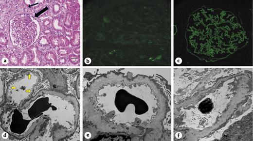 The Continuing Need for Electron Microscopy in Examination of Medical Renal Biopsies: Examples ...