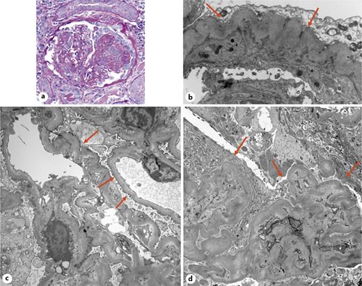Recurrent Glomerular Diseases in Renal Transplantation with Focus on ...