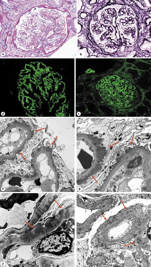 Recurrent Glomerular Diseases in Renal Transplantation with Focus on ...