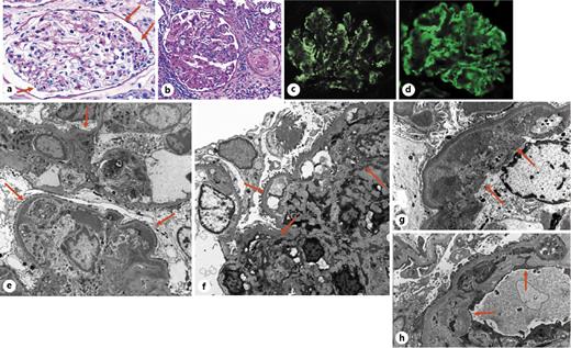 Recurrent Glomerular Diseases in Renal Transplantation with Focus on ...